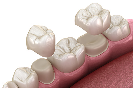 Understanding the Difference Between Veneers and Crowns - A2 Dental Lounge